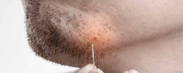 ¿Cómo quitar un pelo enquistado? | Blog Druni