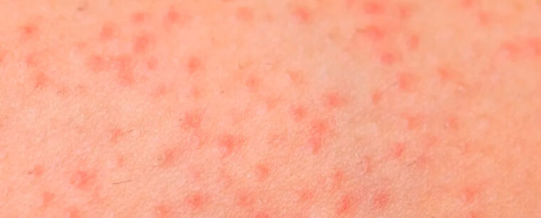 ¿Cómo tratar el sarpullido por calor? | Blog Druni
