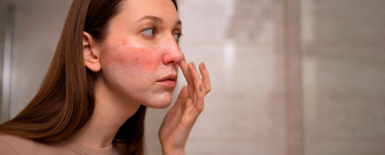 ¿Cómo tratar el sarpullido en la cara? | Blog Druni