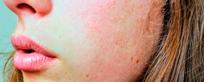 ¿Cómo tratar el sarpullido en la cara? | Blog Druni