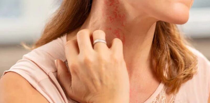 ¿Cómo tratar el sarpullido en la piel? | Blog Druni