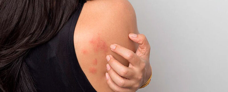 Causas del sarpullido en la espalda: ¿por qué aparece? | Blog Druni
