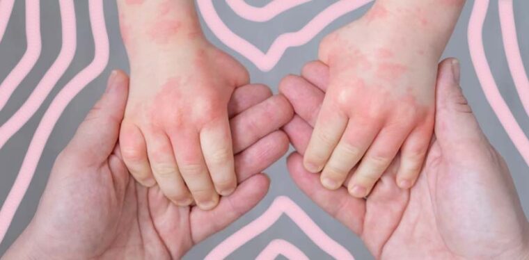 ¿Cómo tratar el sarpullido en la piel? | Blog Druni