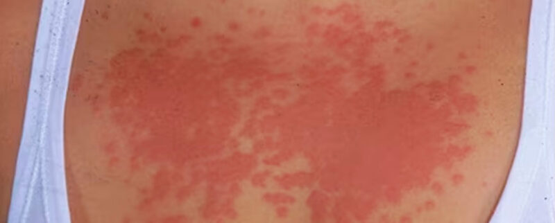 ¿Cómo tratar el sarpullido en el pecho? | Blog Druni
