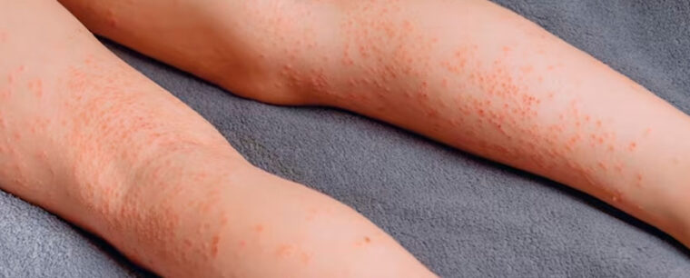 Cómo tratar el sarpullido en las piernas | Blog Druni