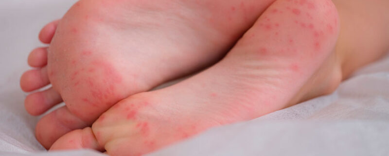 ¿Cómo se cura el sarpullido en los pies? | Blog Druni
