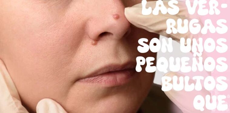 ¿Por qué salen las verrugas en la lengua? y ¿Cómo quitarlas? | Blog Druni