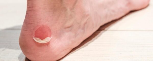 ¿Cómo curar una ampolla reventada o abierta? | Blog Druni