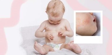 ¿Cómo es la dermatitis seborreica en bebés y cómo se trata? | Blog Druni