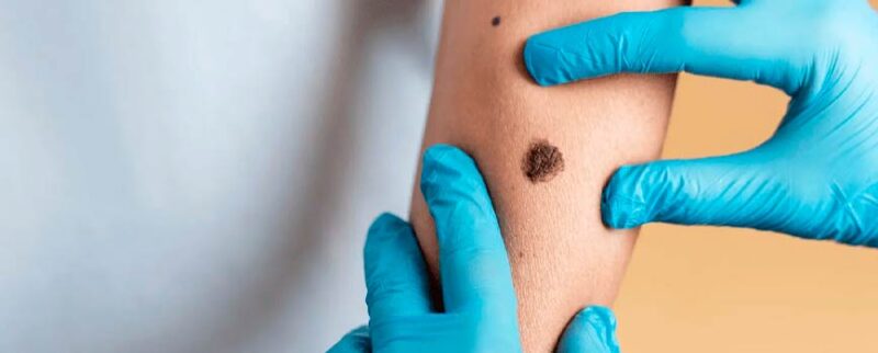 ¿Cómo prevenir los lunares malignos? | Blog Druni