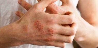 ¿Cómo curar la psoriasis en la cara? | Blog Druni