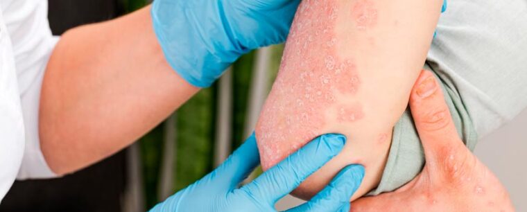 ¿Cómo curar la psoriasis en los codos? | Blog Druni