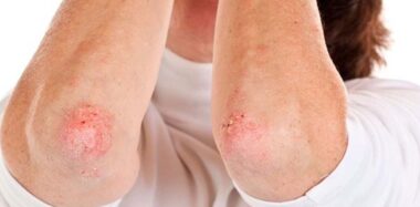 ¿Cómo curar la psoriasis en los codos? | Blog Druni