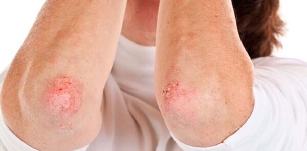 ¿Cómo curar la psoriasis en la cara? | Blog Druni
