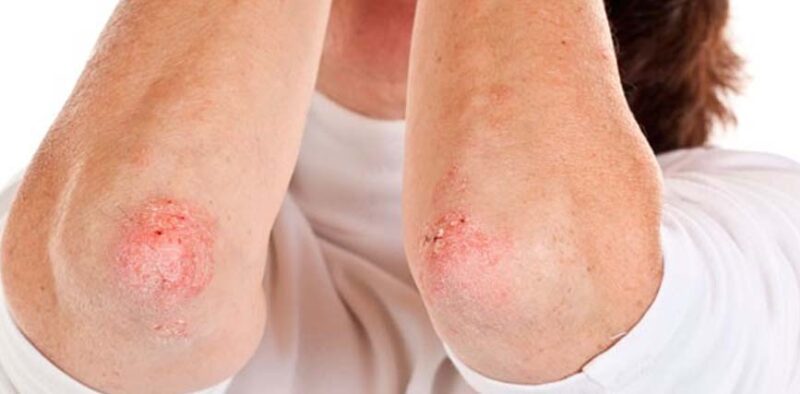 ¿Cómo curar la psoriasis en la cara? | Blog Druni