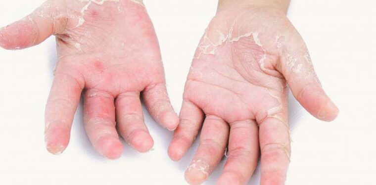 ¿Cómo curar la psoriasis en la cara? | Blog Druni