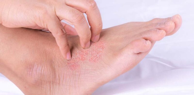 ¿Qué es la psoriasis y cómo curarla? | Blog Druni