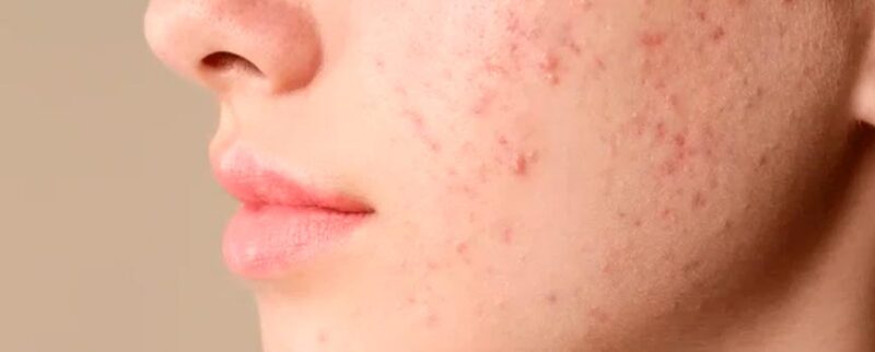 ¿Cómo quitar las espinillas de la cara? | Blog Druni