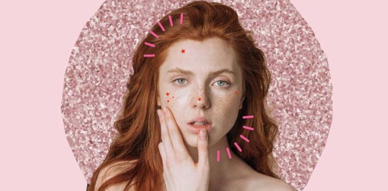 Granos en el labio: qué hacer y cómo tratarlos | Blog Druni