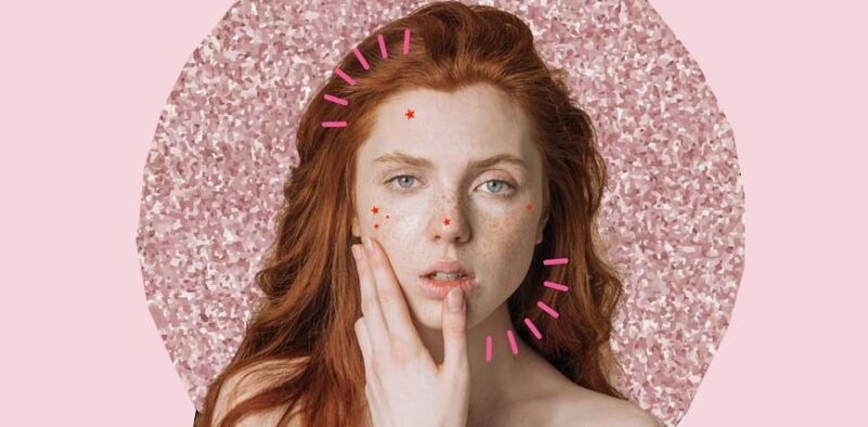 Granos en el labio: qué hacer y cómo tratarlos | Blog Druni