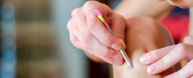 ¿Cómo quitar un pelo enquistado? | Blog Druni