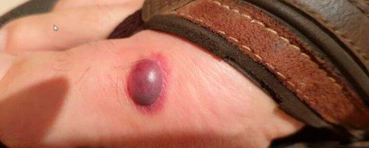 ¿Cómo eliminar correctamente las ampollas de sangre? | Blog Druni