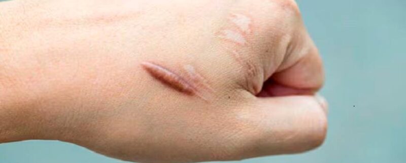 Cicatriz queloide: ¿Qué es y cómo tratarla? | Blog Druni