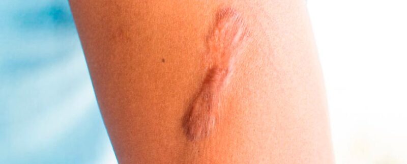 Cicatriz queloide: ¿Qué es y cómo tratarla? | Blog Druni
