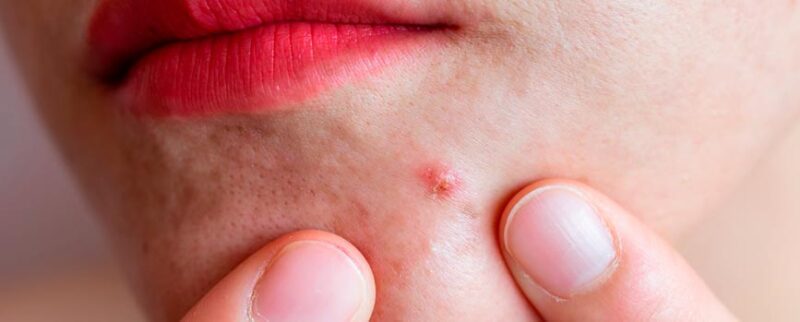 ¿Cómo curar un grano infectado? | Blog Druni