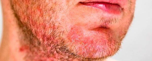 ¿Cómo tratar la dermatitis seborreica en la barba? | Blog Druni
