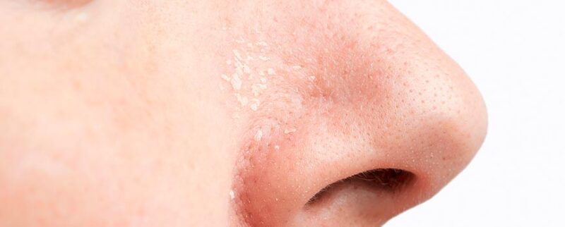 Dermatitis seborreica en la nariz: causas y tratamiento | Blog Druni