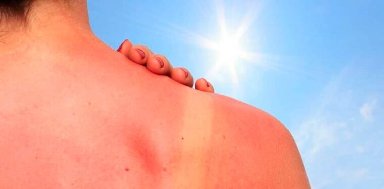 Alergia al sol: qué es, por qué aparece, síntomas y tratamiento | Blog ...