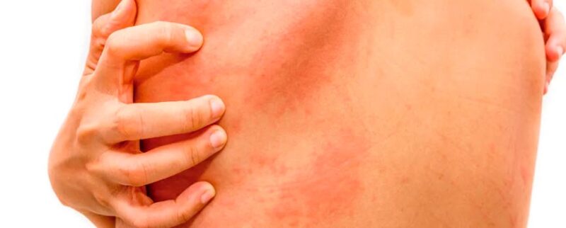 ¿Por qué me salen ronchas en la piel? | Blog Druni
