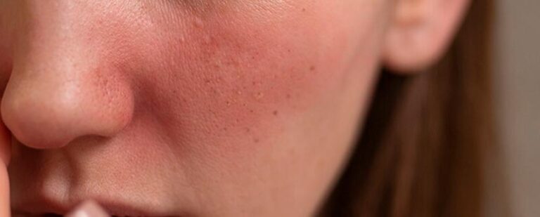 ¿Por qué me salen ronchas en la piel? | Blog Druni