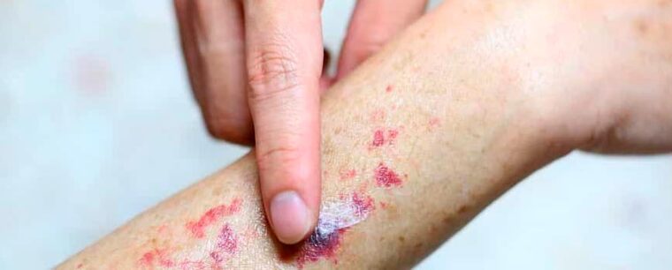 ¿Por qué me salen ronchas en la piel? | Blog Druni