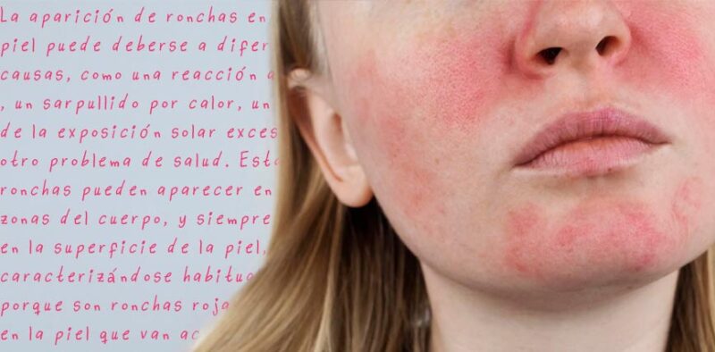 ¿Por qué me salen ronchas en la piel? | Blog Druni