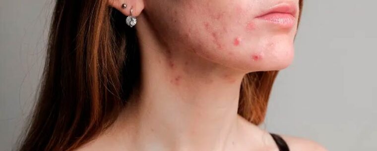 Acné hormonal: causas y tratamiento | Blog Druni