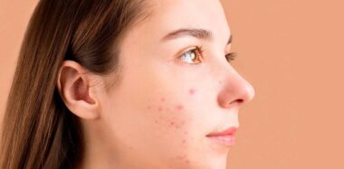 Granos en el labio: qué hacer y cómo tratarlos | Blog Druni