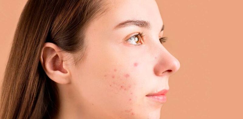 Granos en el cuello y nuca: qué hacer y cómo tratarlos | Blog Druni