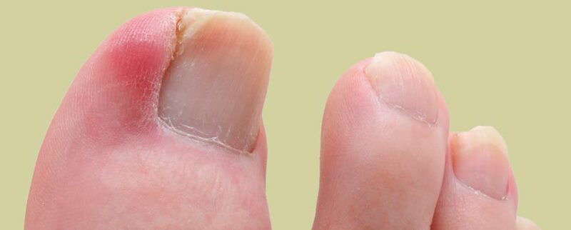 ¿Qué son los uñeros? ¿Cómo curarlos correctamente? Te lo contamos ...