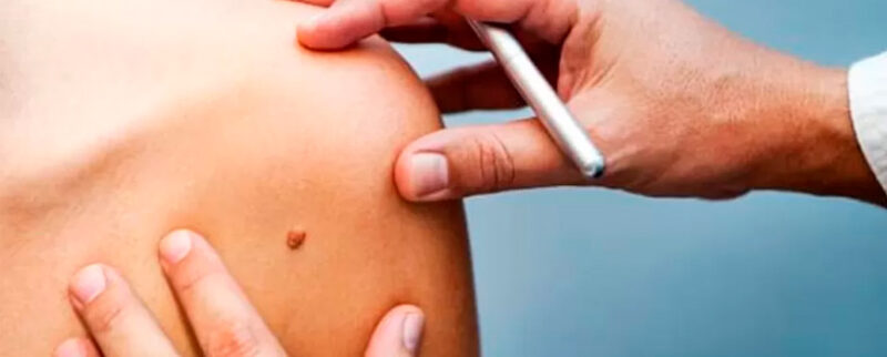 ¿Es peligroso ese lunar? Guía completa para identificar lunares ...