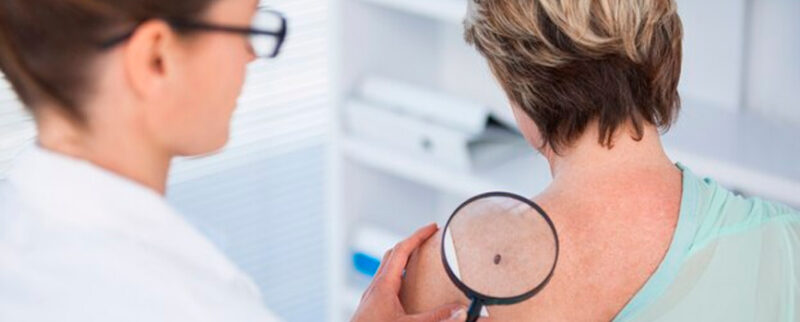 ¿Es peligroso ese lunar? Guía completa para identificar lunares ...