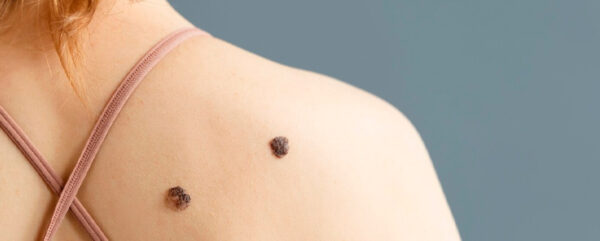 ¿Es peligroso ese lunar? Guía completa para identificar lunares ...