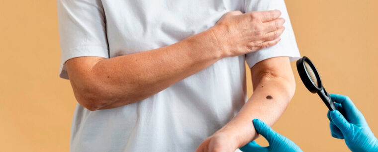 ¿Es peligroso ese lunar? Guía completa para identificar lunares ...