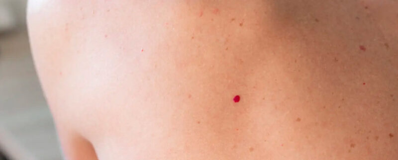 Lunares rojos en la piel: descubre las causas y qué puedes hacer | Blog ...