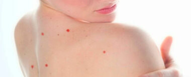 Lunares rojos en la piel: descubre las causas y qué puedes hacer | Blog ...