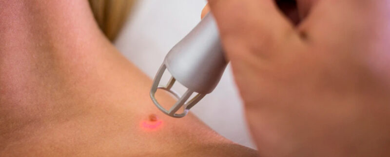 Lunares rojos en la piel: descubre las causas y qué puedes hacer | Blog ...