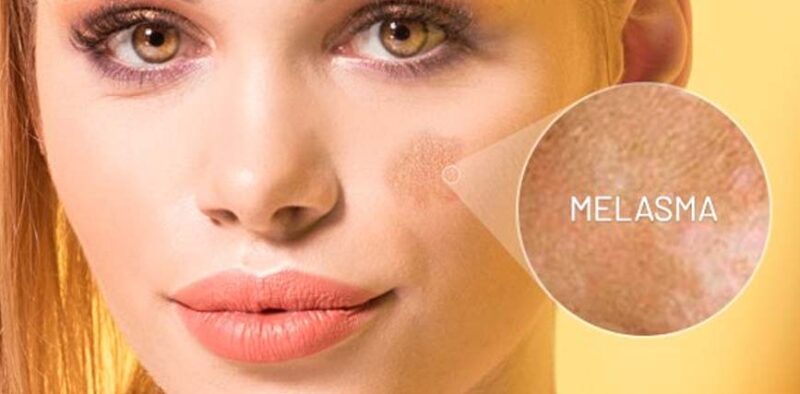 Melasma facial: qué es, cómo evitarlo y los mejores tratamientos | Blog ...