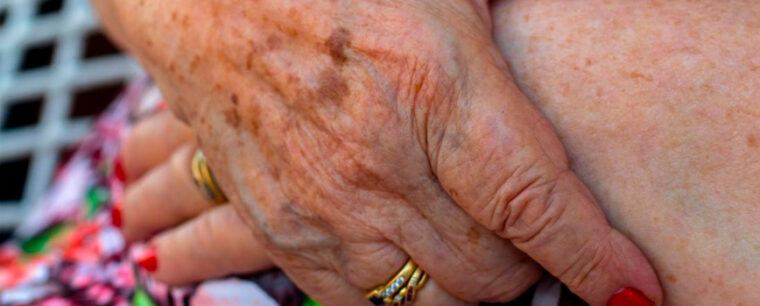Melasma en la piel: causas, síntomas y cómo eliminarlo eficazmente ...