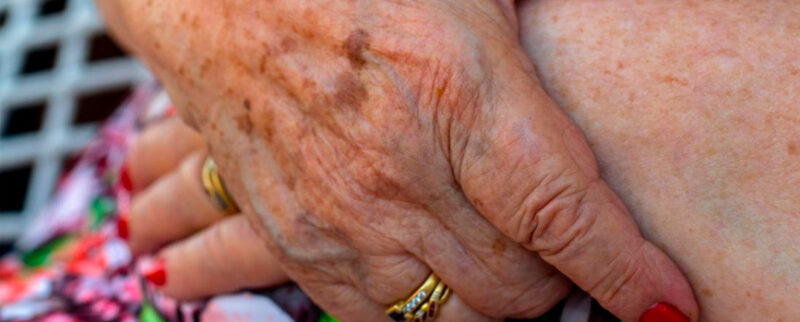 Melasma en la piel: causas, síntomas y cómo eliminarlo eficazmente ...